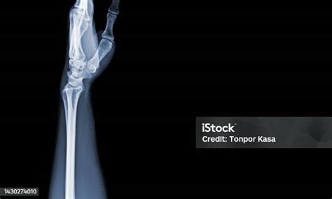 손과 손목 관절의 Xray 이미지는 의료 진단을 위해 부상 힘줄 연조직 붓기를 볼 수 있습니다 의료 이미지 개념 및 복사 공간