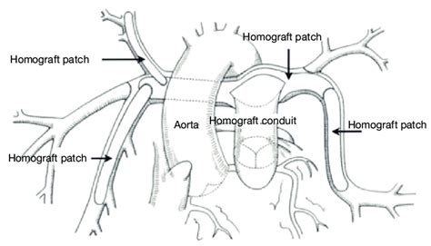 Illustration Demonstrating Complete Repair Of Pa Vsd Mapcas Including Download Scientific