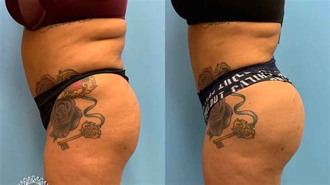 Before And After Brazilian Butt Lift Pics