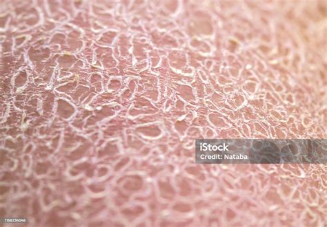태양 노출 후 크고 작은 균열과 죽은 벗겨진 비늘로 덮인 건조한 건강에 해로운 피부 질감의 배경 분홍에 대한 스톡 사진 및 기타 이미지 Istock