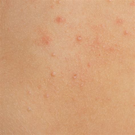 Itchy Skin Bumps On Legs