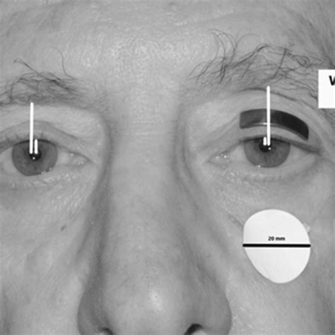 Mean Absolute Mrd1ptb With 95 Confidence Intervals By Weight