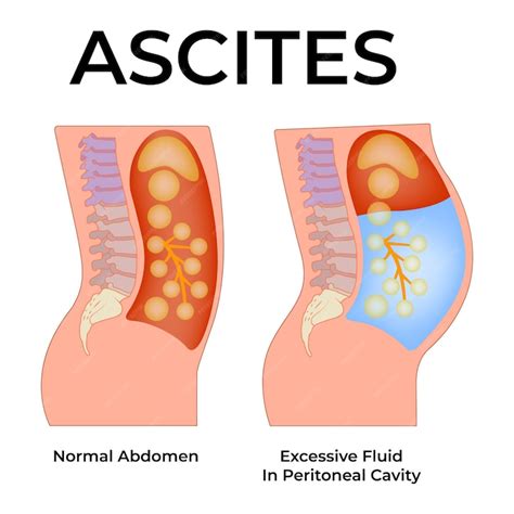 Premium Vector Ascites Normal Abdomen Excessive Fluid In Peritoneal