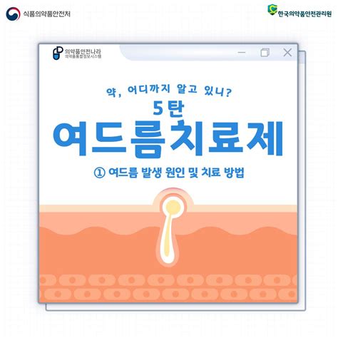 💊약 어디까지 알고 있니 📌5탄 여드름치료제 ① 여드름 발생 원인 및 치료 방법 무더운 여름이 되면 고온다습한 기온으로 인해 얼굴에 열이 올라🥵 피지 배출량이 많아지게