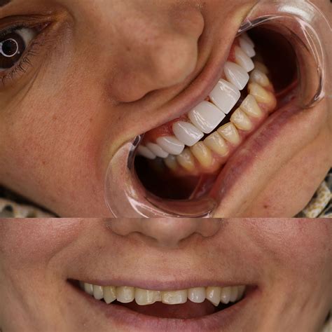 آیا دندان خراب و پوسیده را می توان کامپوزیت کرد کلینیک دندانپزشکی