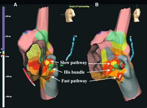 Catheter Ablation Of Atrioventricular Nodal Reentrant Tachycardia In