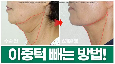 이중턱 지방은 얼굴형에 따라 빼는 방법이 다르다🤔🤔 이중턱 근육묶기 이중턱 지방흡입 Youtube