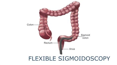 Flexible Sigmoidoscopy Youtube