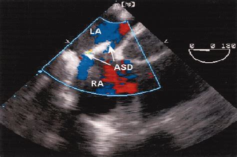 Echocardiogram View Classification By Deep Learning Model Download