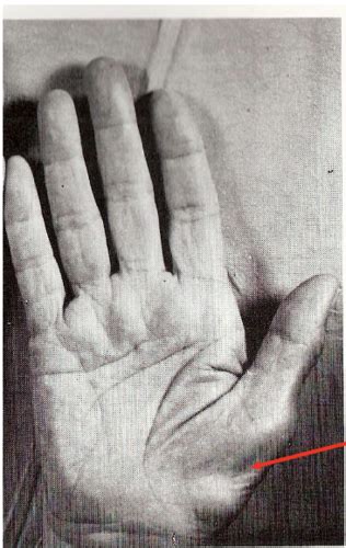 Neuropathies And Plexopathies Of The Upper Limb Flashcards Quizlet