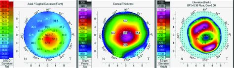 Three Map Composite Pentacam Image Of A Left Keratoconic Cornea The