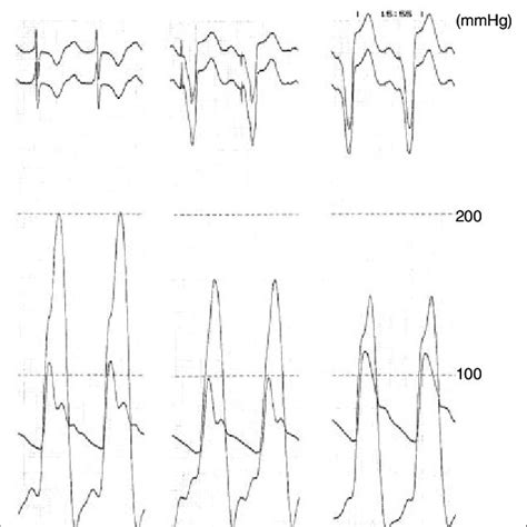 Simultaneous Recordings Of Left Ventricular Apex And Aortic Pressure