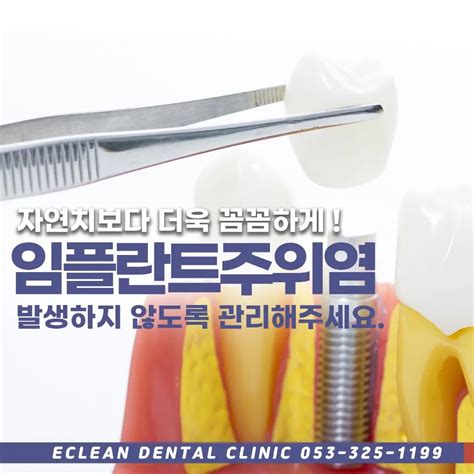 이클린치과 안녕하세요 이클린치과입니다 👨‍⚕️ 임플란트 주위염이란 임플란트를 식립하고