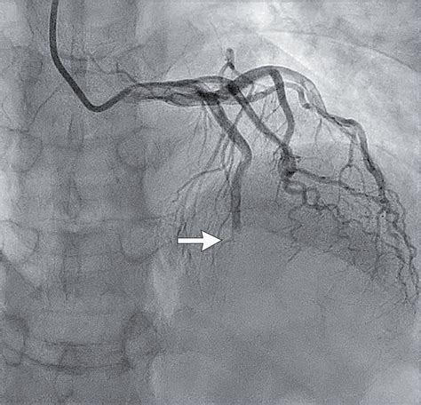 The New England Journal Of Medicine A 36 Year Old Man Who Had Aids With Kaposis Sarcoma Was