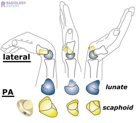 Scaphoid And Lunate Fossa