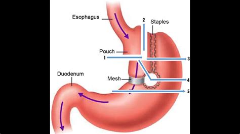 Vertical Banded Gastroplasty Cpt Code Simplify Medical Coding Youtube