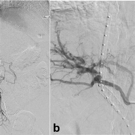 Digital Subtraction Angiogram Images From The Procedure Show A Widely