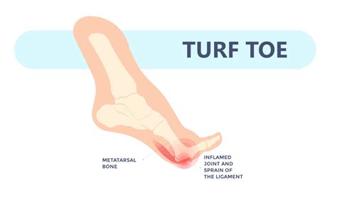 Everything You Need To Know About Turf Toe Priority Podiatry