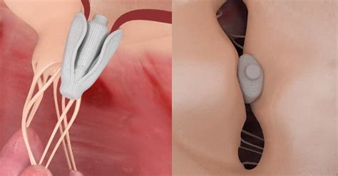 Edwards Pascal Improves Mitral Regurgitation In Early Trial Results