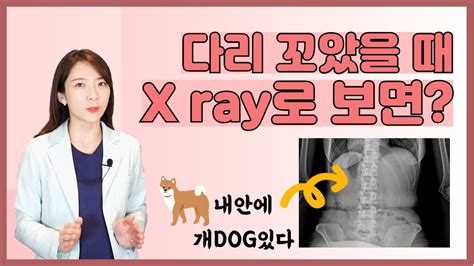 다리 꼬았을 때 X Ray로 내 허리를 본다면 다리꼬는자세 골반틀어짐 척추틀어짐 Youtube