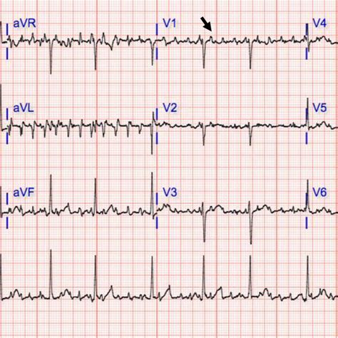 Pdf Electrocardiographic Artifact Potentially Misleading To The Wrong