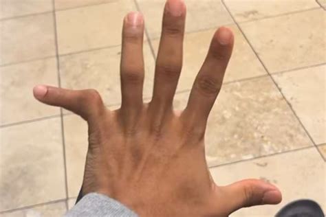 Broken Finger Football At Lawrence Henry Blog