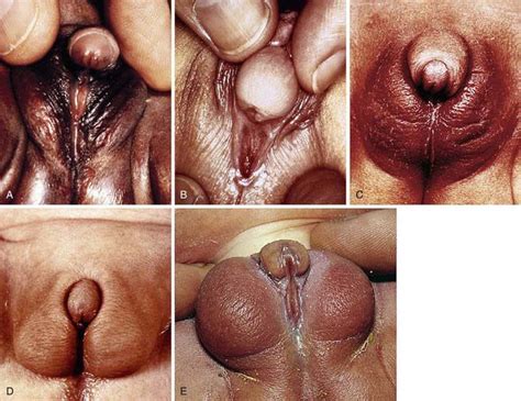 Disorders Of Sex Development Clinical Gate