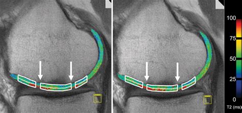 Quantitative T2 Mapping Of Knee Cartilage Differentiation Of Healthy