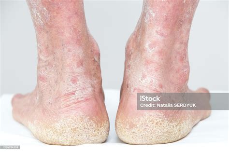 남성 다리와 발 뒤꿈치에 급성 건선은 자가 면역 불치피부피부질환이다 다리에 큰 빨강 염증 벗겨지기 쉬운 발진 건선에 대한 스톡 사진 및 기타 이미지 Istock
