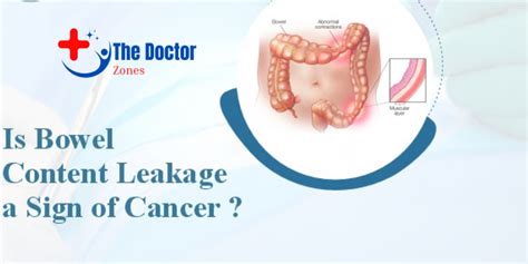 Is Bowel Leakage A Sign Of Cancer Bowel Leakage Causes Thedoctorzones
