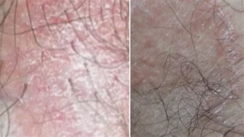 Invers Psoriasis Vs Skridtsvamp Kend Forskellen Mednote