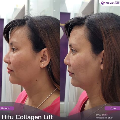 Hifu Before And After Photos Siam Clinic Thailand