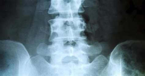 Common Causes Of Facet Arthropathy