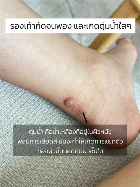 รองเท้ากัดจนพองเป็นตุ่มน้ำ จำเป็นต้องเจาะไหม แกลเลอรีที่โพสต์โดย Kkacha Lemon8