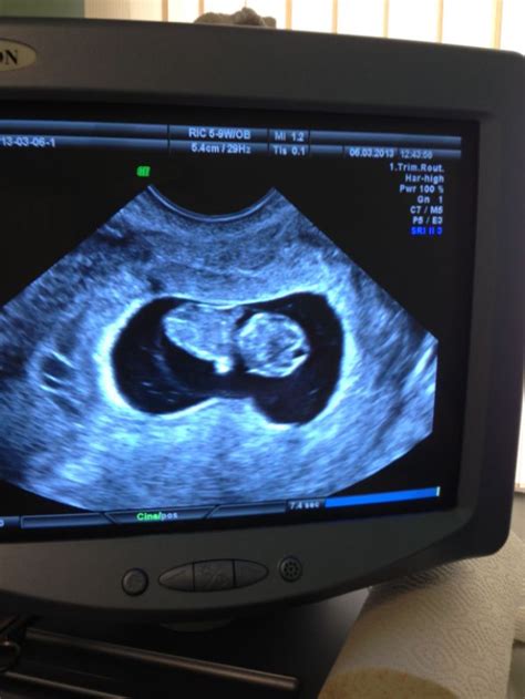 Фото УЗИ от пользователя Анастасия Москва Россия на 9 неделе беременности