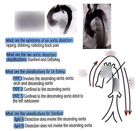 Aortic Dissection Classification Diagram Quizlet
