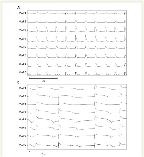 A Recordings Of Monophasic Action Potentials Of An Isolated Rabbit Download Scientific