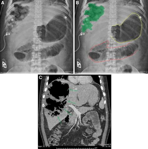 1a Abdominal Radiograph Demonstrating A Hepatic Abscess B Large Cavity Download Scientific