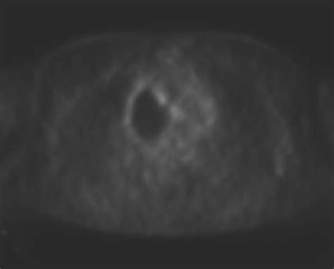 Angiosarcoma Cardiac Radiology Case Studies Ctisus Ct Scanning