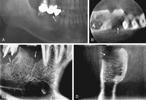 Incisive Nerve Block Anesthesia Key