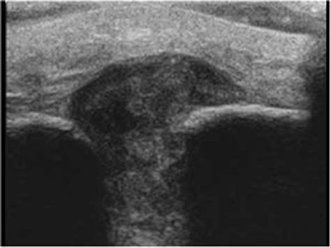 Musculoskeletal Joints And Tendons 61 Shoulder Case 6123
