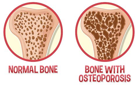 Premium Vector Comparison Of Normal Bone And Bone With Osteoporosis