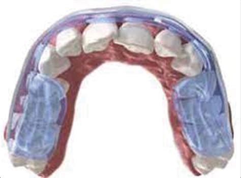 Tmj Splint Not Working At Andres Lowe Blog