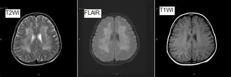 A Case Of Metachromatic Leukodystrophy Mld With Mr Images Showing Download Scientific