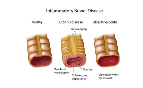 Ibd What Is Ibd Ibdrelief