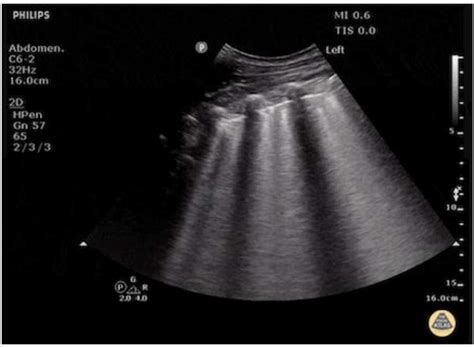 Point Of Care Ultrasound Evaluation Of Respiratory Function Wfsa