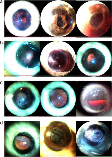 A Pigment Dispersioniris Atrophy B Wide Variation In Iris And Download Scientific Diagram