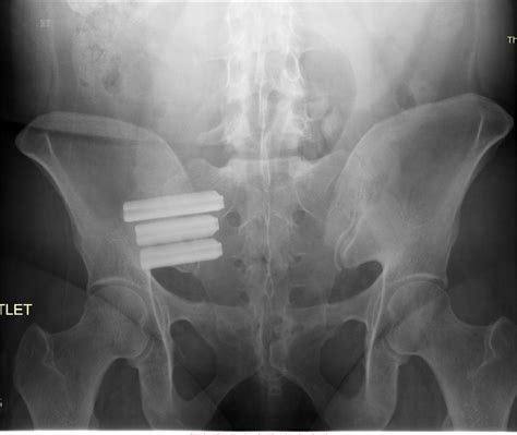 Sacroiliac Joint X Ray