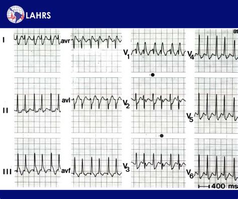 Ritmo Cardiaco Medicalcondition Scope