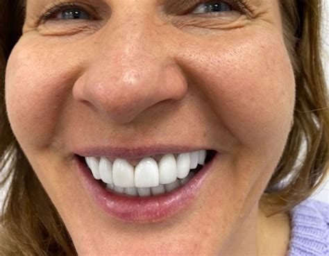 How Long Do Turkey Teeth Last Turkey Vs Uk